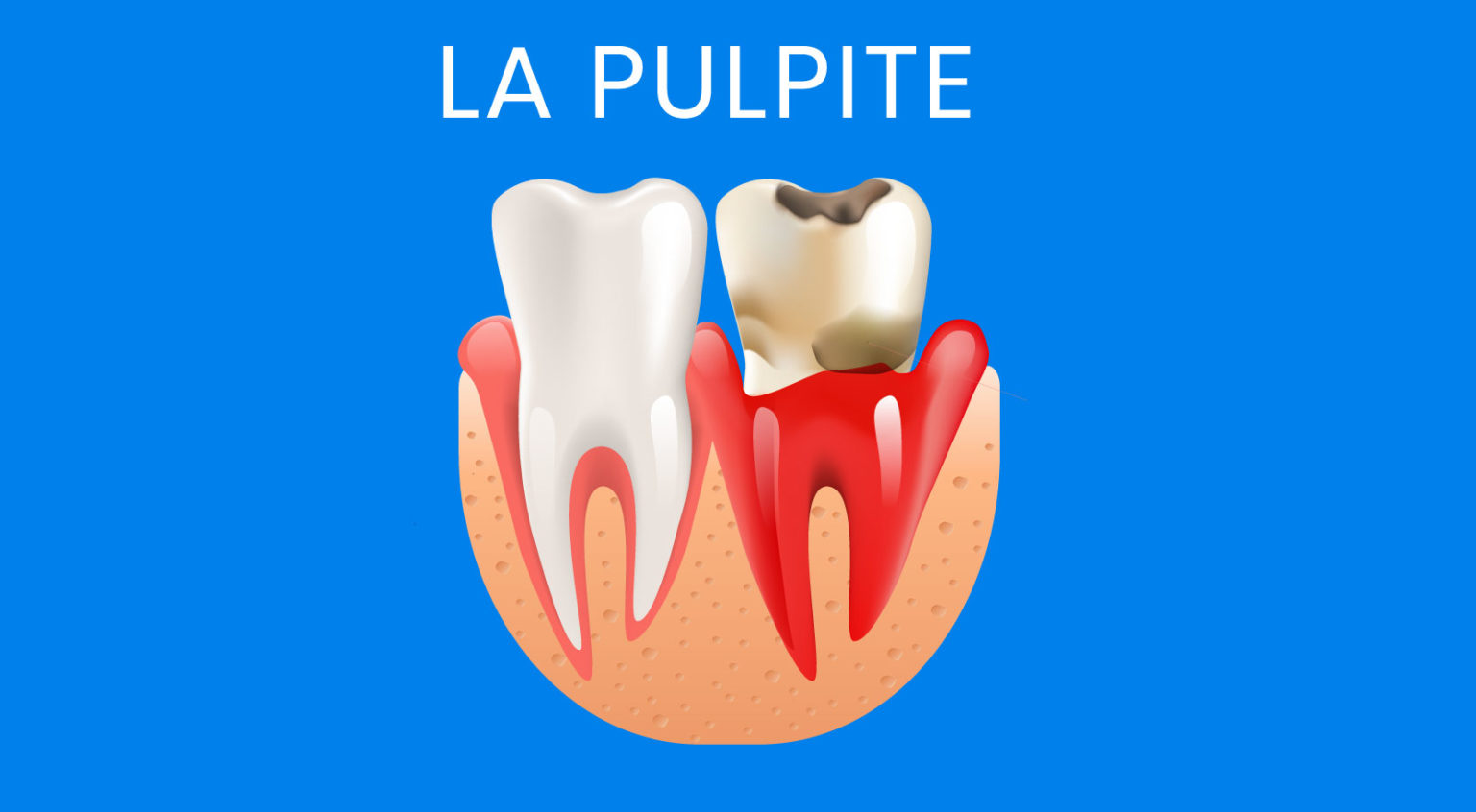 La pulpite: cos'è, sintomi e cura | Studio dentistico Ireos dental