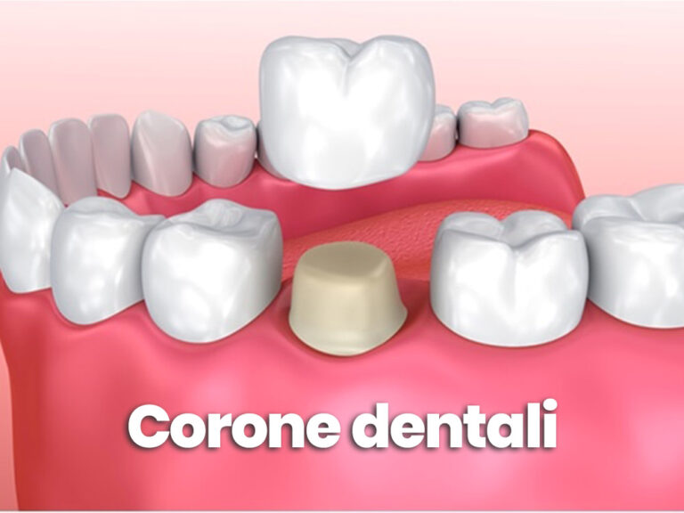 Differenza fra corone e ponti dentali - Dentista Firenze | Clinica odontoiatrica Ireosdental