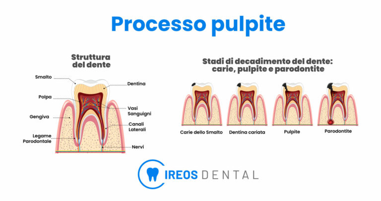 La pulpite: cos'è, sintomi e cura | Studio dentistico Ireos dental