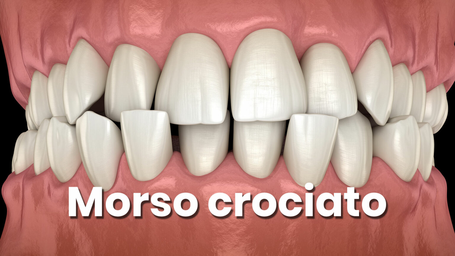 Cos’è il morso crociato: cause, sintomi e soluzioni | Ireos dental