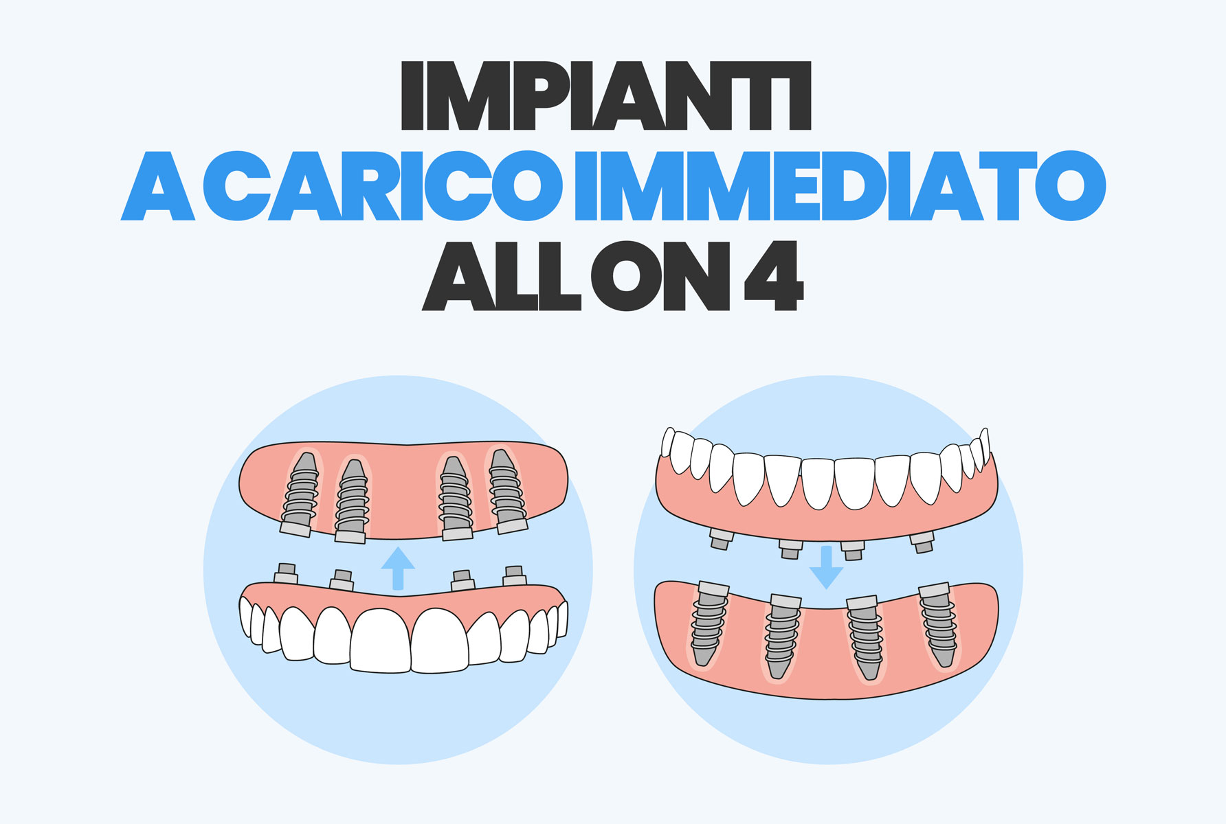 Implantologia a carico immediato - Denti fissi e stabili